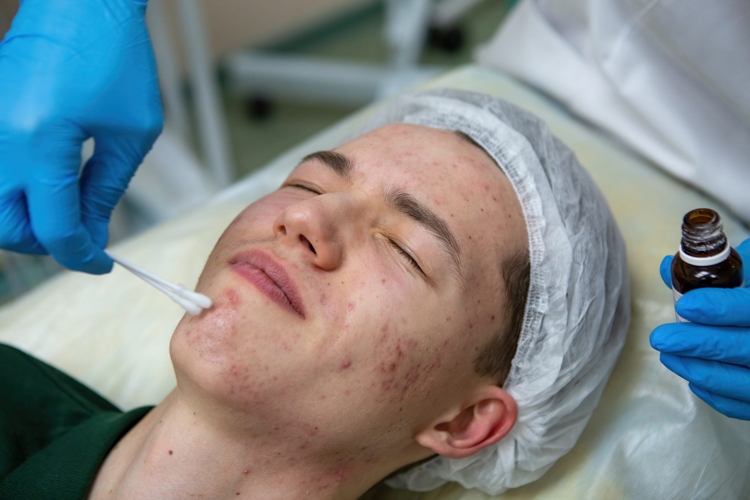 Teenage Pimples – Science Skincare