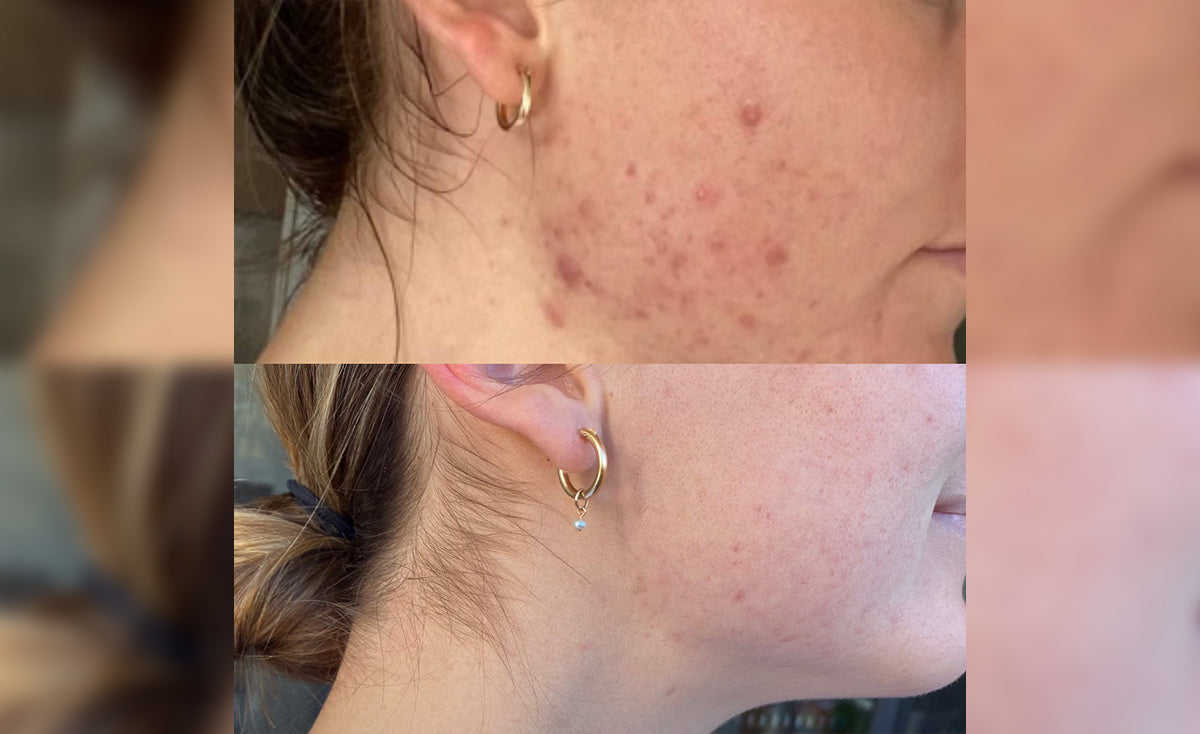 Case Study: Bye, Bye BlemishesTM! – Science Skincare